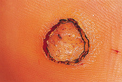 Skin Infections Transmitted | Matguard