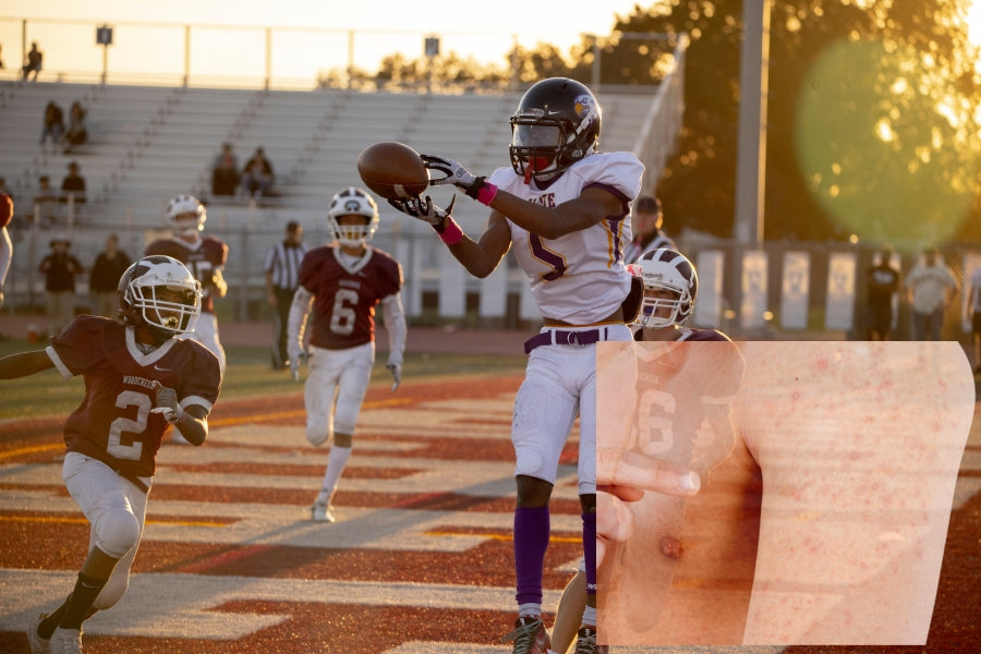 Heat Rash From Football Pads | Matguard