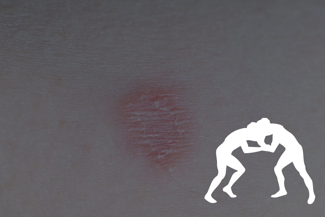 How Does Ringworm Spread? Causes, Risks & Prevention | Matguard