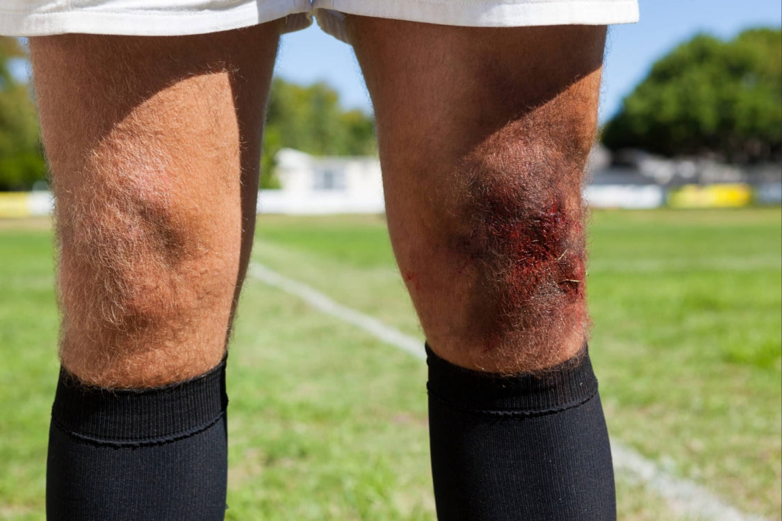 Turf Burn: A Guide | Matguard